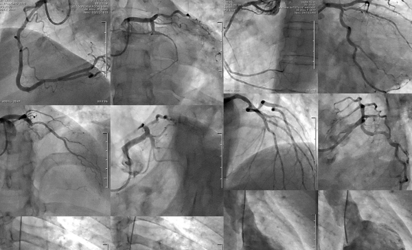 Cateterismo Cardíaco – CIMI - Medicina Cardiovascular